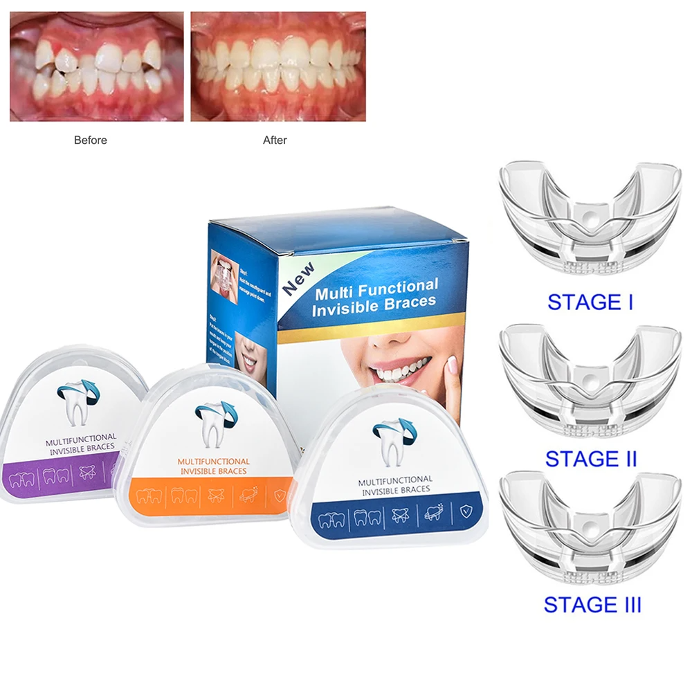 Dental Aligner Braces- Orthodontic Teeth Alignment Brace Trainer – The ...